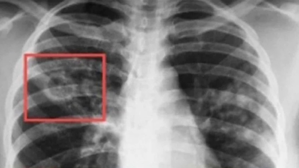 Bulgaria: Free Checkups for Tuberculosis Begin in All Regional Capitals ...