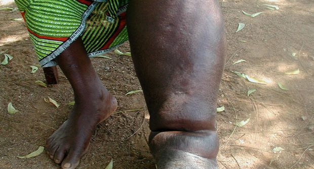 GHS advocates the inclusion of elephantiasis patients in health ...